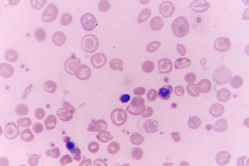 Nombre de globules rouges nucléés: qu'est-ce que cela peut signifier ...